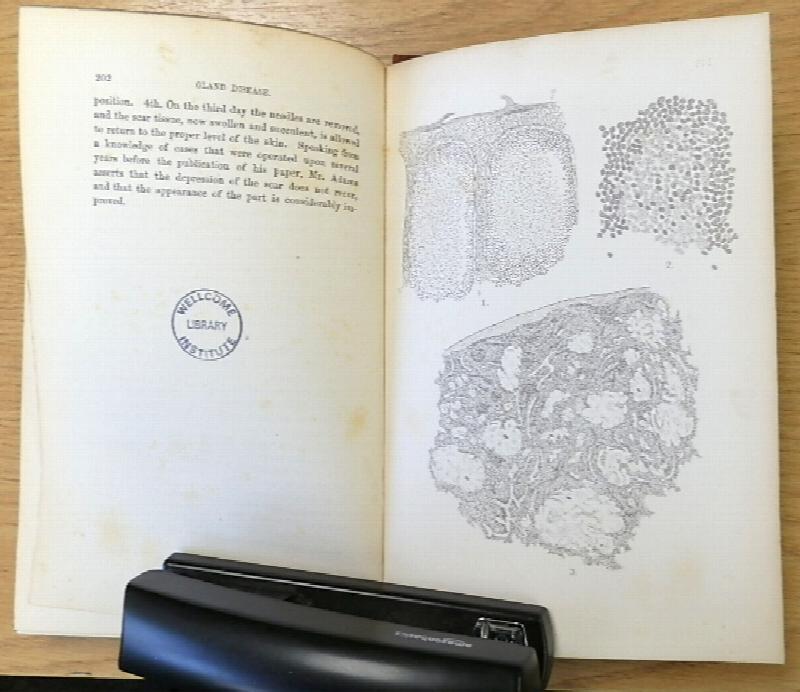 Scrofula and Its Gland Diseases: An Introduction to the General ...